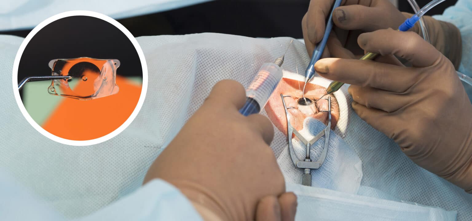 Lentes intraoculares ICL: en qué casos están indicadas | Blog D'Opeluce