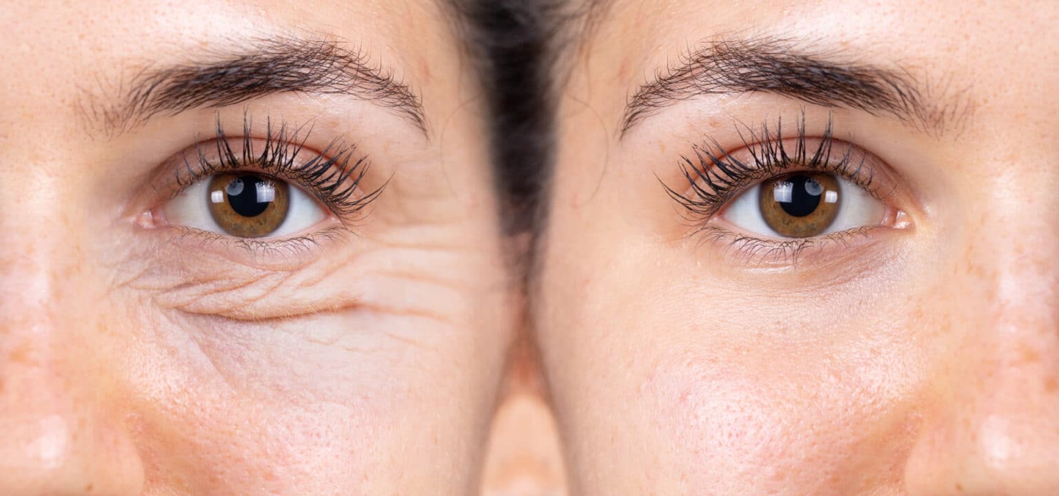 Blefaroplastia o cirugía de párpados: ¿en qué consiste? | Blog D'Opeluce