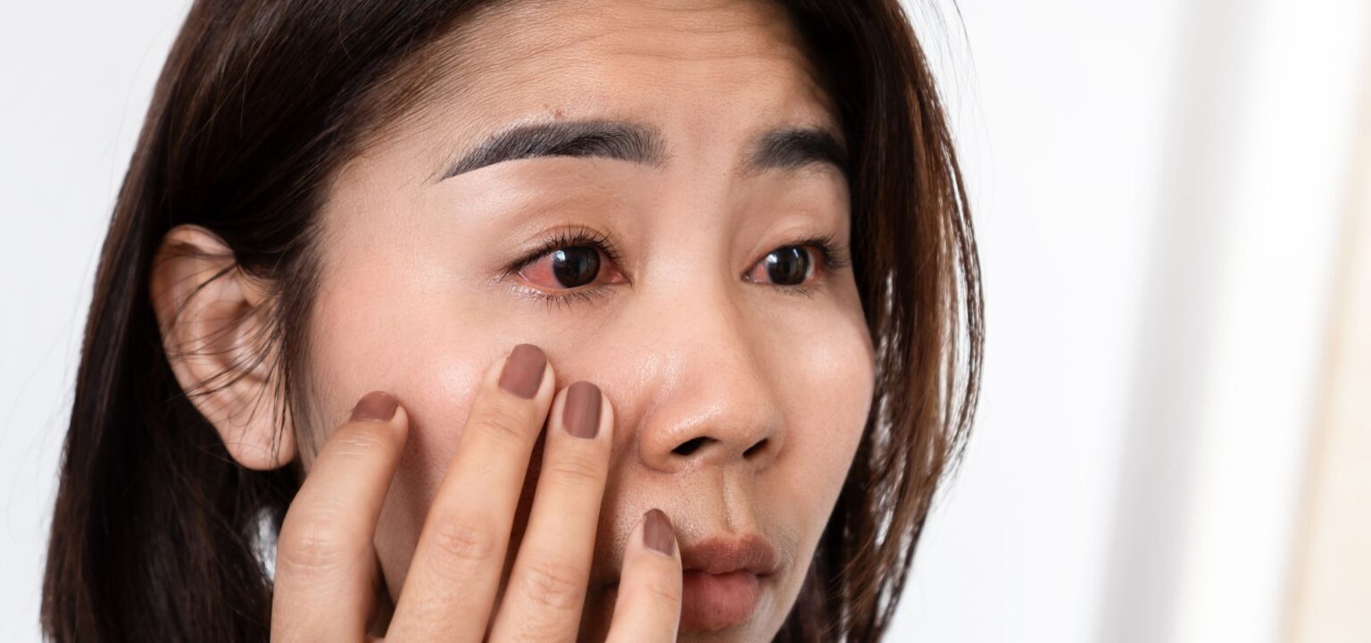 Ojo rojo: ¿por qué se produce y cuánto puede durar? | Blog D'Opeluce